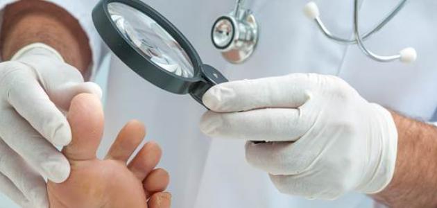 Fungus in the human body